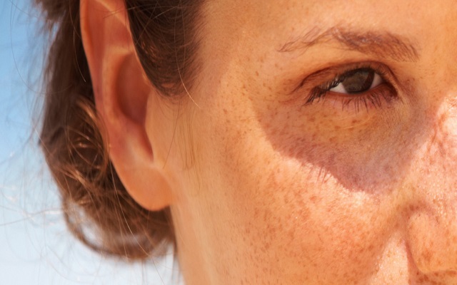 Fotodermatosis Exógenas