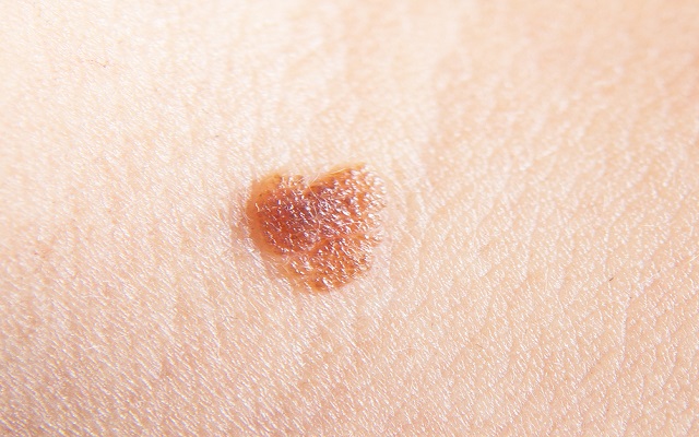 Melanoma